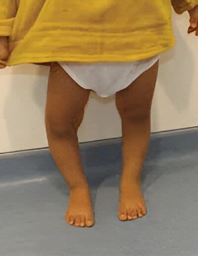 Upper And Lower Limb Deformity Correction In Thane Dr Vinod Dubey