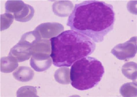 Acute Myeloblastic Leukemia Aml M1 Download Scientific Diagram