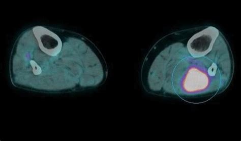 Multiple Hypermetabolic Nodular Lesions In Various Skeletal Muscle