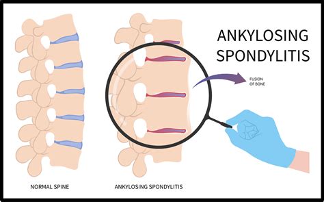 Ankylosing Spondylitis Orthoeducation