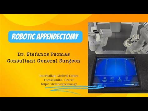 Stefanos Psomas On Linkedin Robotic Appendectomy For Acute