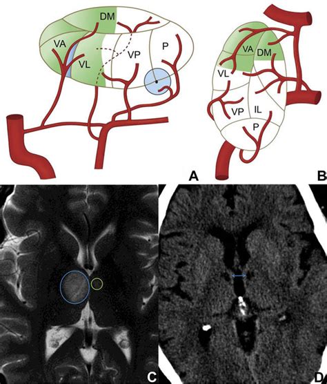 Schematic Diagram Of Lateral A And Dorsal B Views Of Tuberothalamic