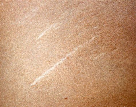 How To Remove Stretch Marks Phoenix Liposuction