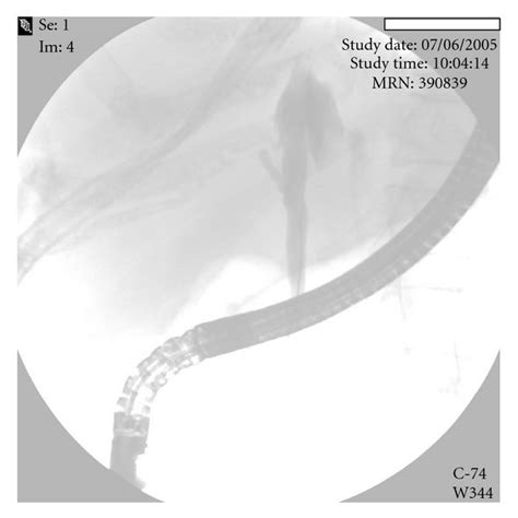 Ercp Showing A Stop At The Level Of The Biliary Confluence And A