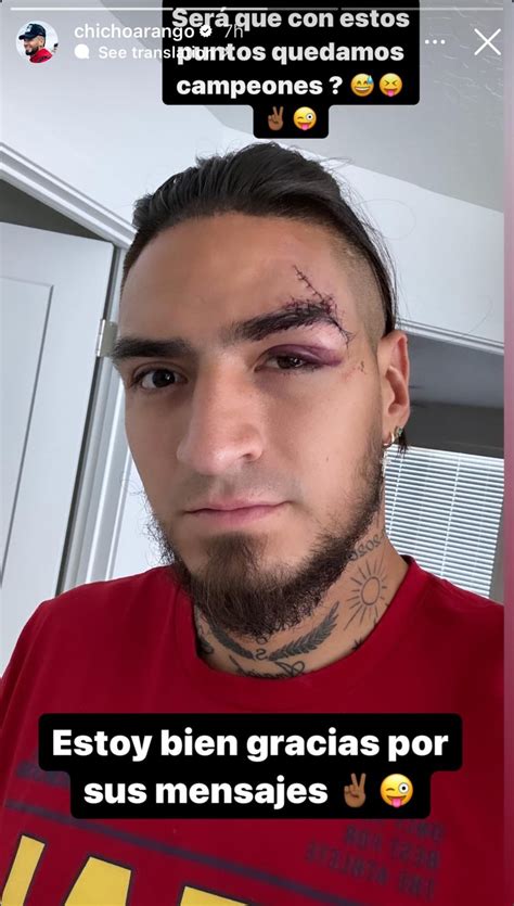 Chicho Received Stitches After The Match On Saturday Rmls
