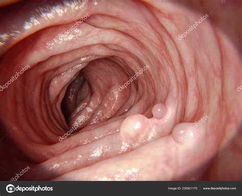 Intestinal Polyps Rendering Polyps Growth Tissue Occurring Lining Colon