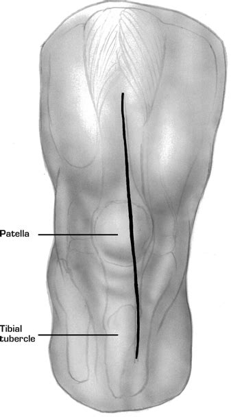 The Medial Parapatellar Approach To The Knee Musculoskeletal Key