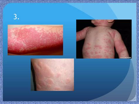 Paediatric Rashes Pptx