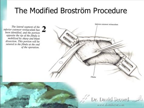 Broström Procedure Presentation