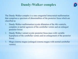 Dandy Walker Syndrome Ppt