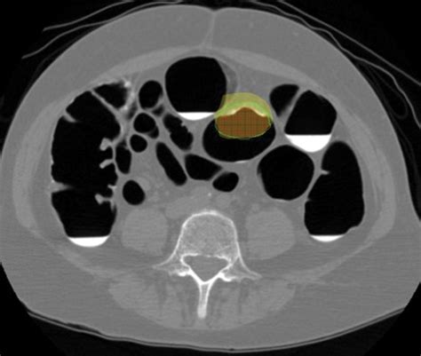 Ct Texture Analysis Definitions Applications Biologic Correlates
