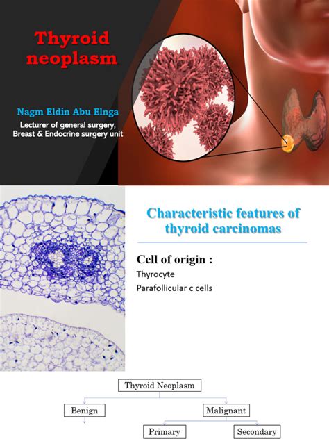 Thyroid Cancer And Post Thyroidectomy Complications Pdf Carcinoma Thyroid