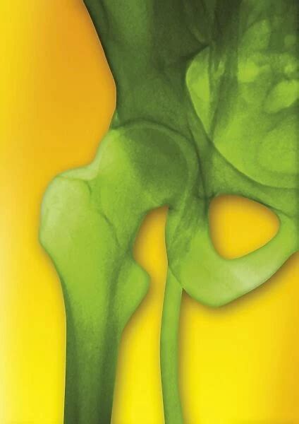 Normal Pelvic Veins Venogram Photos Framed Prints Puzzles Posters Canvas 6388245