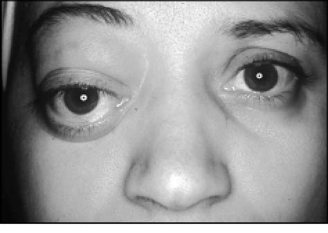 Paciente Con Exoftalmos Secundario A Nfs 1989 Download Scientific