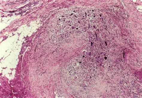 2 丛状纤维组织细胞瘤 外科病理疑难病例鉴别诊断