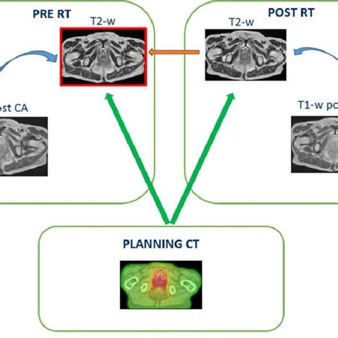 Schematic Overview Of The Image Registration And Contour Propagation Download Scientific