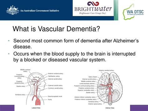 Ppt Vascular Dementia Powerpoint Presentation Free Download Id3120510