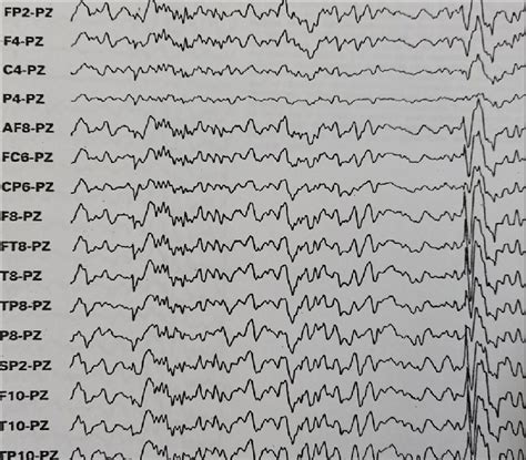 Electroencephalogram Showing Sharp Waves At Right Temporal Region With