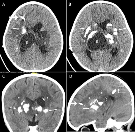 Computed Tomography Scans Axial A B Coronal C And Sagittal D