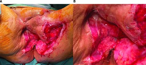 A Human Amniotic Membrane Application B Human Amniotic Membrane Download Scientific