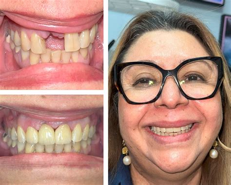 Teeth Before And After