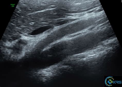 Nutcracker Syndrome Drkalirajanscans