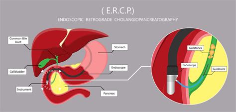 Ercp Procedure Singapore Alpha Digestive And Liver Centre Ercp Procedure Singapore Alpha Digestive And Liver Centre