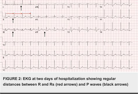 Figure 2 From Transient Atrial Fibrillation After Epinephrine Use For