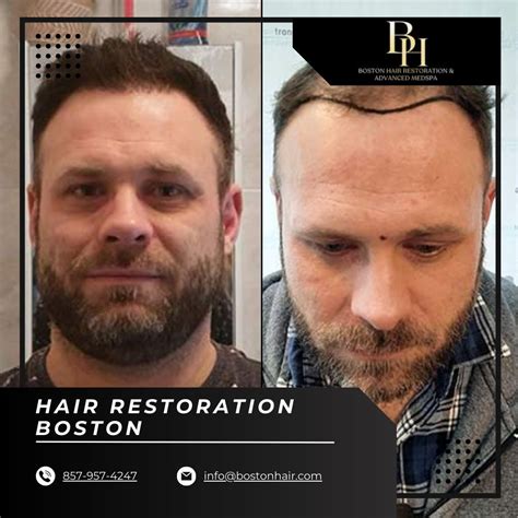 Regain Your Confidence Best Hair Restoration Choices In Boston