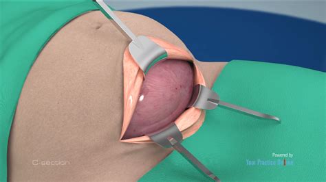 Cesarean Section Procedure