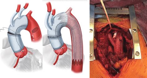 Zone 2 Arch Repair Zone 2 Aortic Arch Repair With Debranching Of The Download Scientific