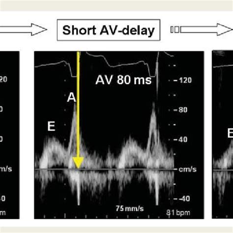 Av Interval Optimization With The Iterative Method From A Long Av Download Scientific Diagram
