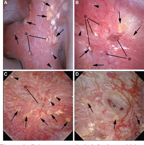 Figure 2 From A Proposed Grading System To Standardize The Description Of Renal Papillary