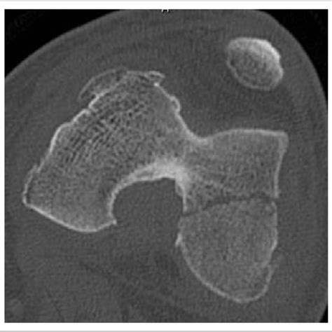 Axial Computed Tomography Ct Scan With Coronal Fracture Line