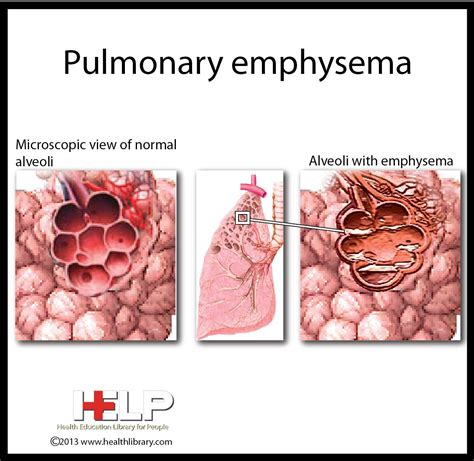 Pulmonary Emphesema Systems Art Nursing Notes Pulmonary