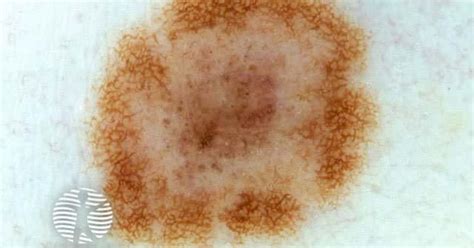 Dermoscopy Image