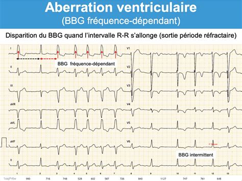 Blocs E Cardiogram