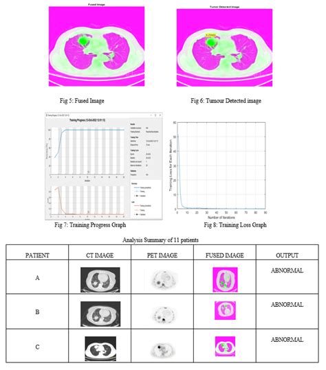 lung cancer detection using fusion cnn and yolo in matlab