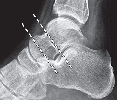 Talus Bone Fracture Xray At Luis Manson Blog