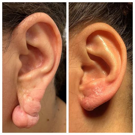 Ear Reconstructive Surgery Jacksonville Dermatology And Cosmetic Surgery
