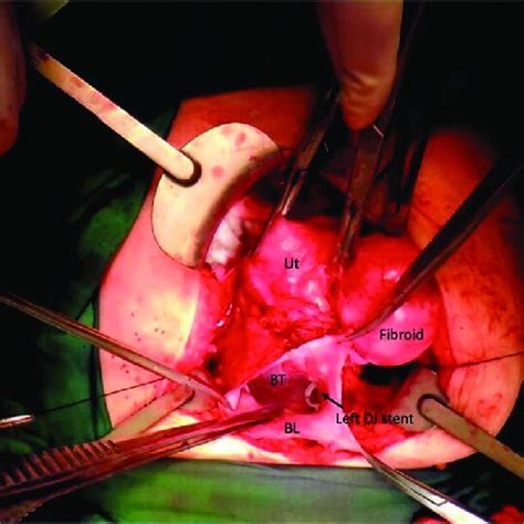 Intraoperative Image Showing The Relationship Between The Bladder Bl Download Scientific
