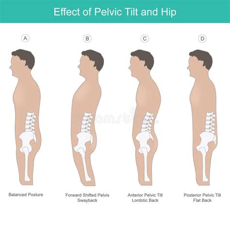 Pelvic Tilt Stock Illustrations 24 Pelvic Tilt Stock Illustrations
