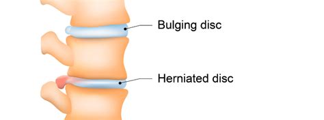 Bulging Disk Heres Why Your Herniated Disk Can Get Better