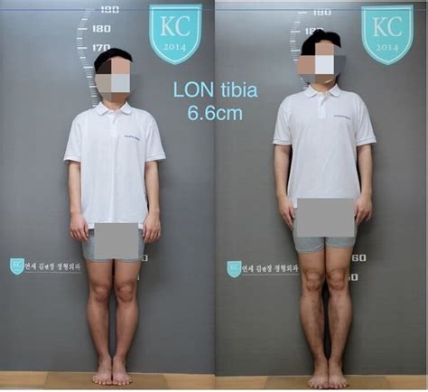 Limb Lengthening Surgery Cost Procedure Recovery And Results