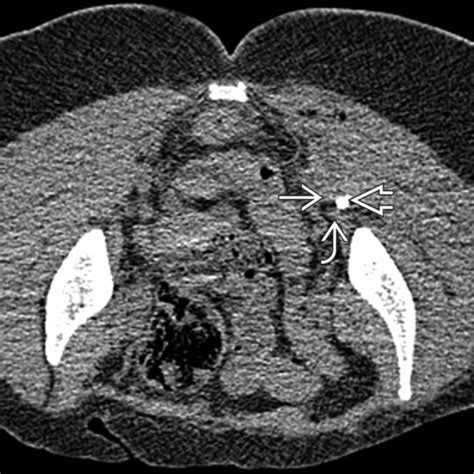 Piriformis Steroid Injection Clinical Tree