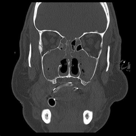 Le Fort Fracture Classification Pacs