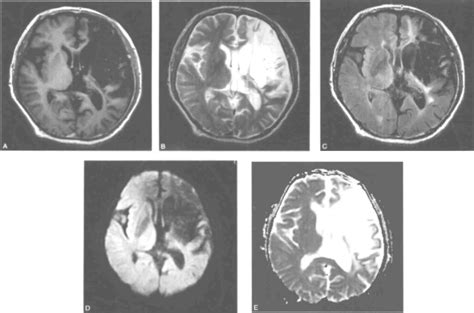 一、脑梗死 神经外科诊疗及并发症