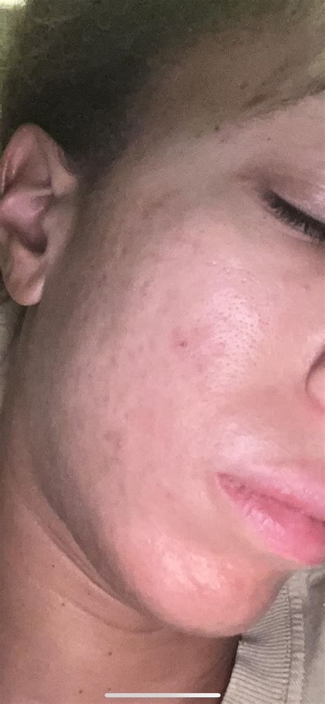 Accutane Vs Amnesteem Racne