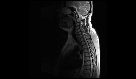 Epidural Hematoma Mri
