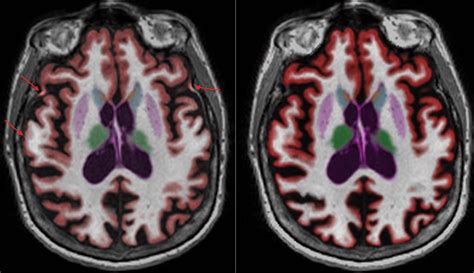 Neuroquant 40 Tba Report Updates And Traumatic Brain Injuries Cortechsai